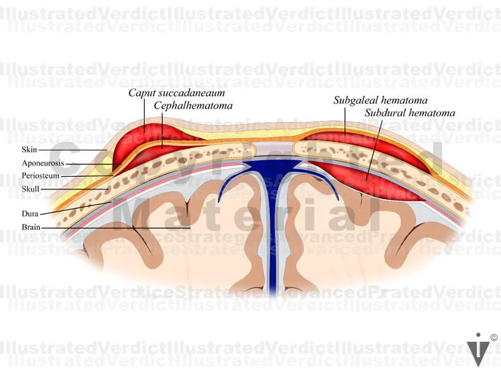 Stock Pregnancy / Delivery: Vacuum / Forceps — Illustrated Verdict