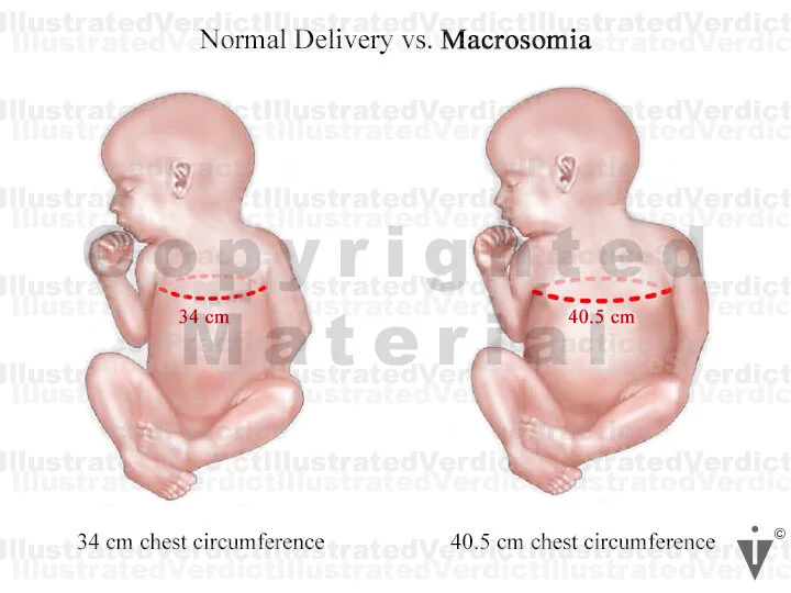 Stock Pregnancy / Delivery: Shoulder Dystocia / Maneuvers — Illustrated ...
