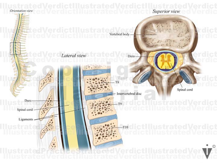Stock Spine: Epidural — Illustrated Verdict