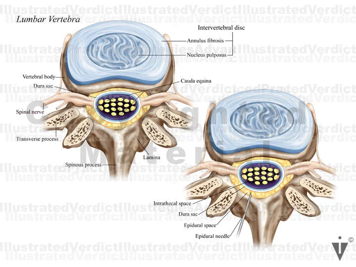 Stock Spine: Epidural — Illustrated Verdict