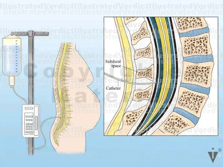 Stock Spine: Epidural — Illustrated Verdict