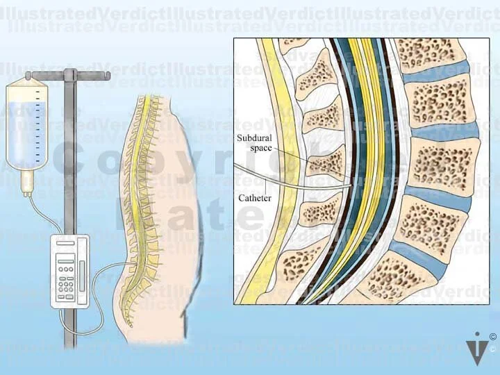 Stock Spine: Epidural — Illustrated Verdict