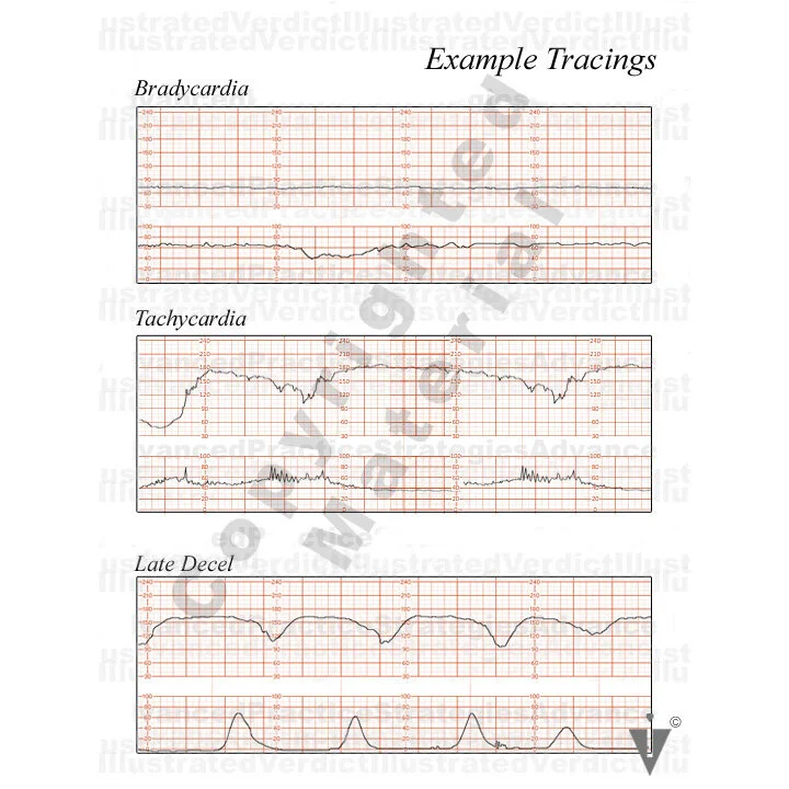 Stock Fetal Strips: Tracing Examples (from cases) — Illustrated Verdict
