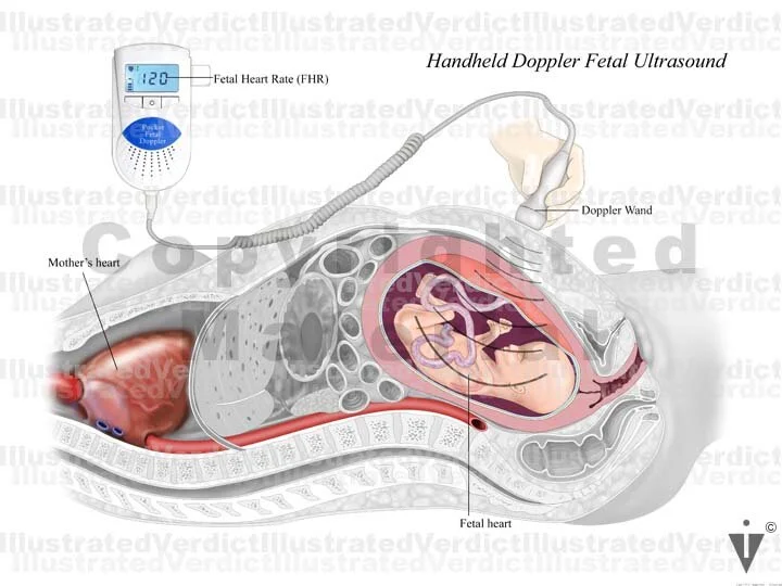 Stock Fetal Strips: Fetal Monitoring Illustrations — Illustrated Verdict