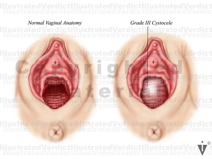 Stock Female Pelvis Prolapse Rectocele Cystocele — Illustrated Verdict