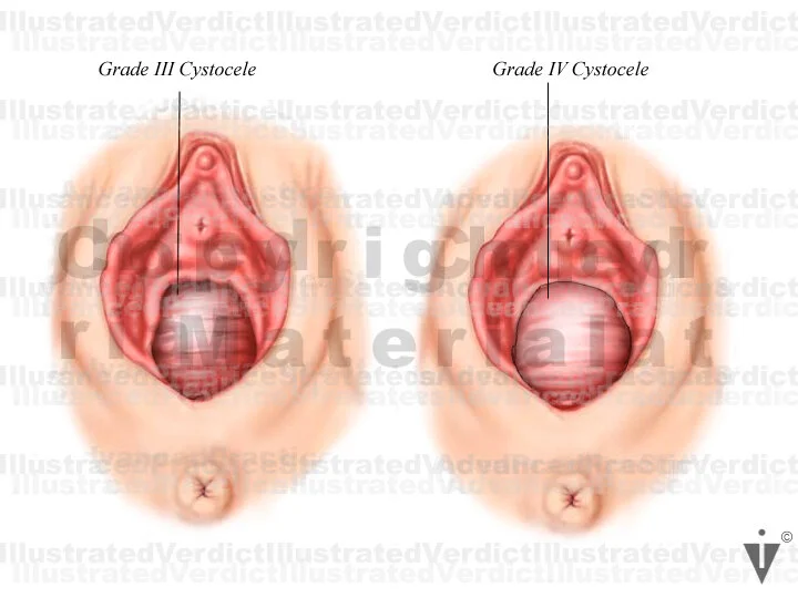 Stock Female Pelvis Prolapse Rectocele Cystocele — Illustrated Verdict