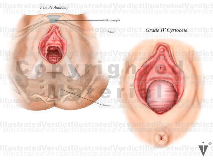 Stock Female Pelvis Prolapse Rectocele Cystocele — Illustrated Verdict