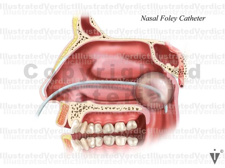 Stock Nose / Sinus: Anomalies / Surgery — Illustrated Verdict
