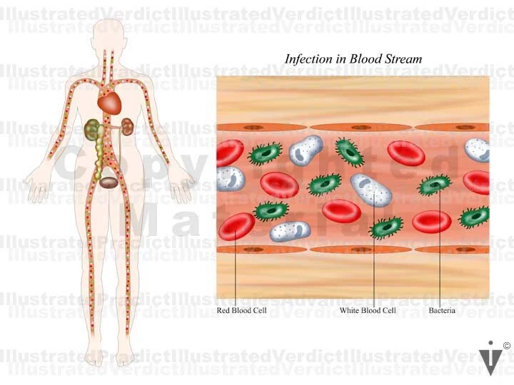 Stock Sepsis: Sepsis Overview — Illustrated Verdict