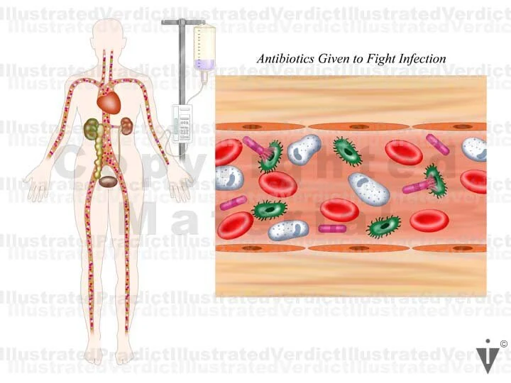Stock Sepsis: Sepsis Overview — Illustrated Verdict