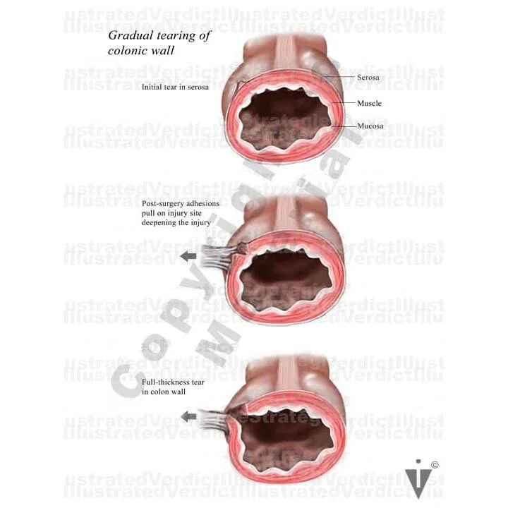 Stock Female Pelvis: Bowel / Colon Injuries / Repair — Illustrated Verdict