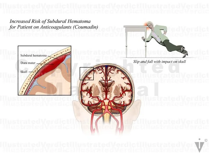 Stock Brain: Hemorrhages — Illustrated Verdict