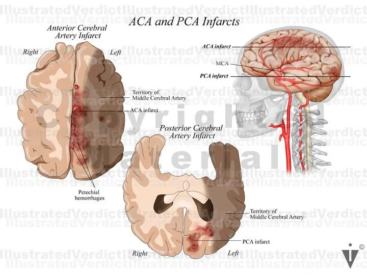 Stock Brain: Stroke — Illustrated Verdict