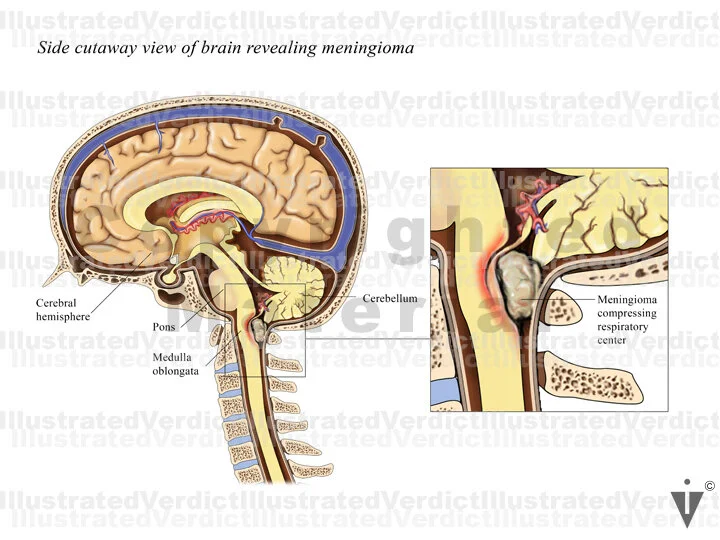 Stock Brain Tumors Illustrated Verdict