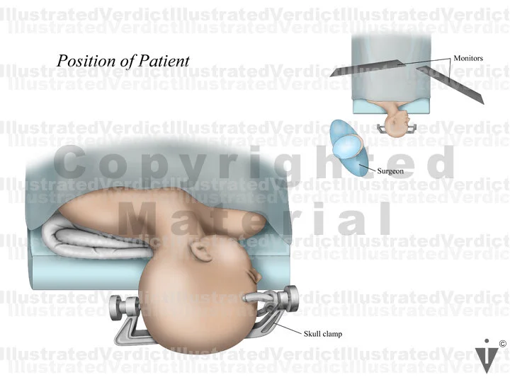 Stock Brain: Surgical Approaches — Illustrated Verdict
