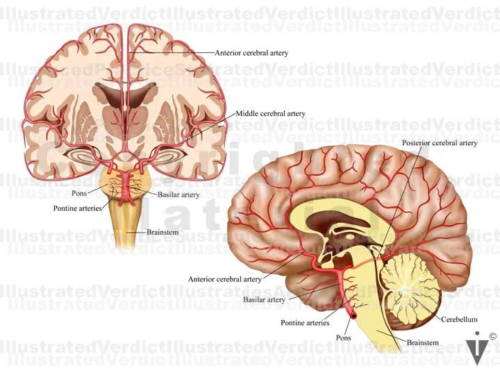 CASE AT A GLANCE: Brain Subdural Hematoma — Illustrated Verdict