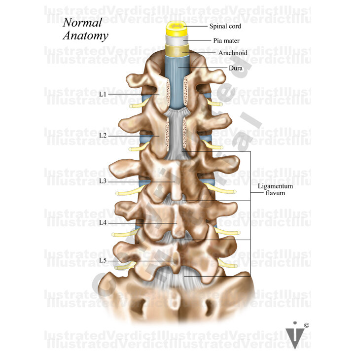 CASE AT A GLANCE: Spinal Cord Stimulator Removal — Illustrated Verdict