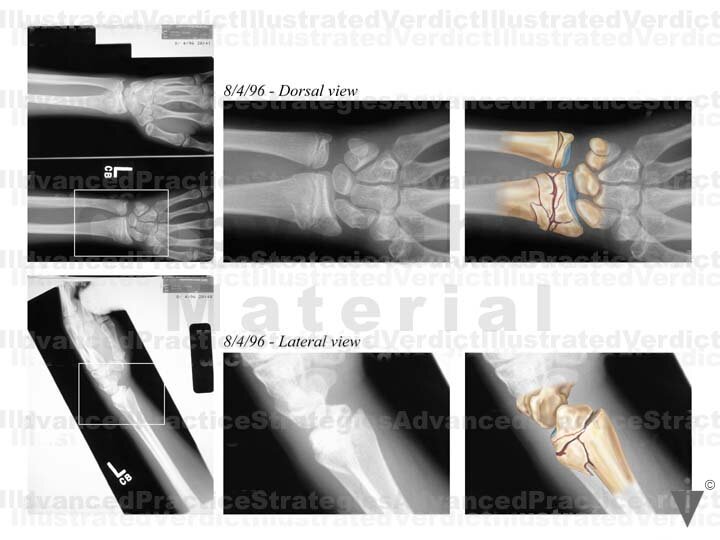 Stock Upper Limb: Hand — Illustrated Verdict