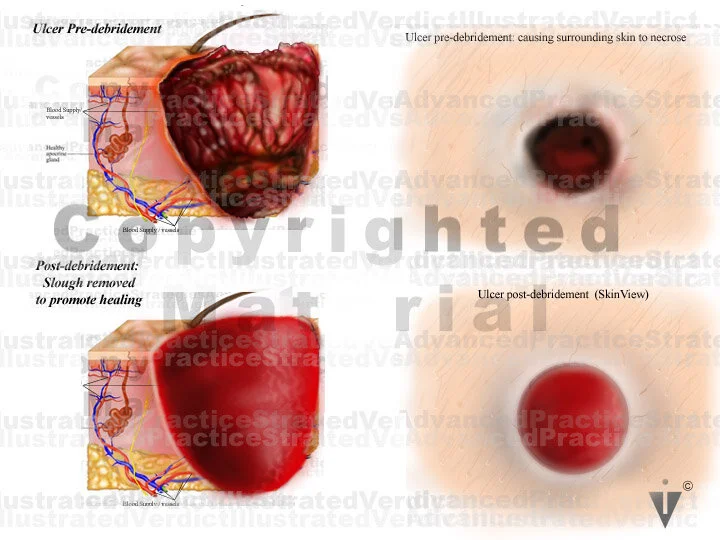 Stock Sepsis: Sepsis Overview — Illustrated Verdict