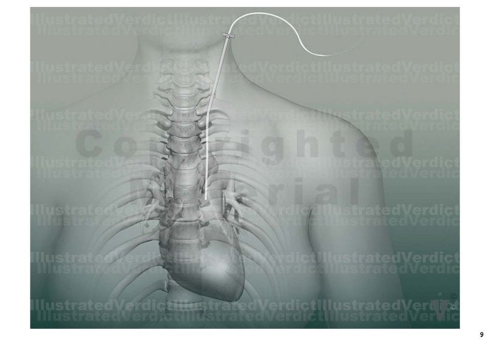 CASE AT A GLANCE: Chemo Port Placement Venous Access — Illustrated Verdict