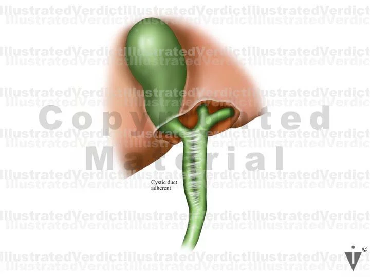 Stock Gallbladder: Variations (ducts, arteries, stones, tumors ...