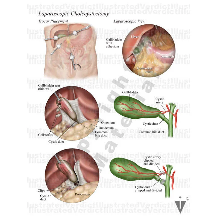 Stock Gallbladder: Laparoscopic Cholecystectomy — Illustrated Verdict