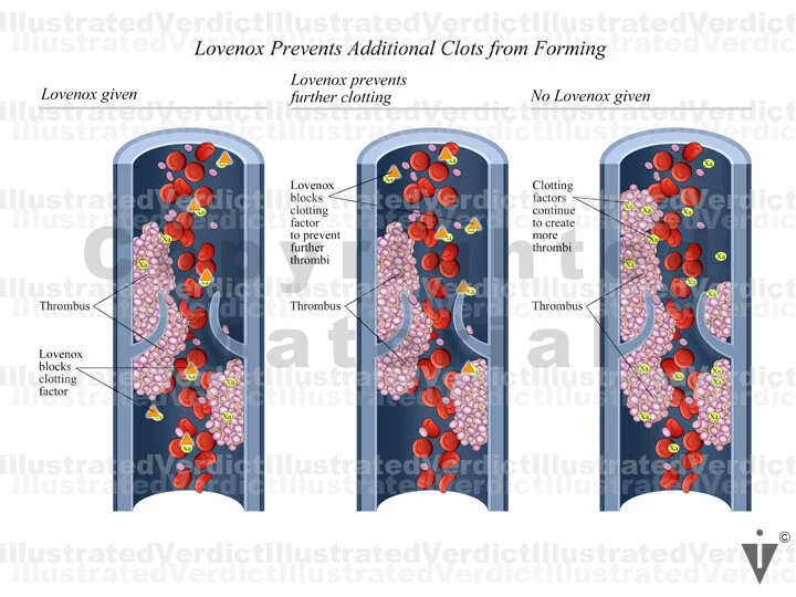 CASE AT A GLANCE: Extensive DVT and Anticoagulants — Illustrated Verdict