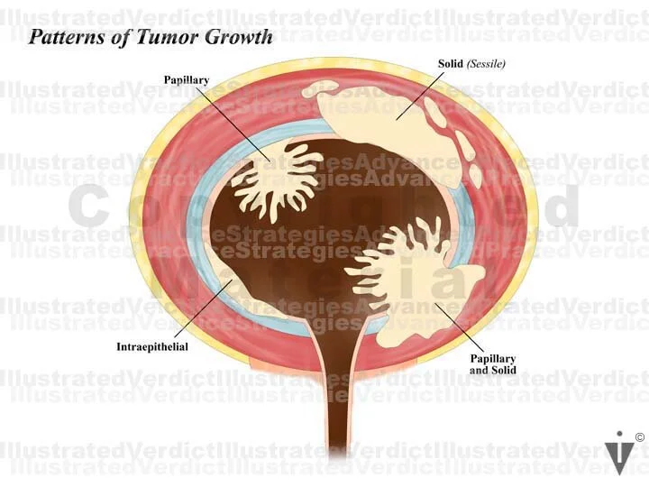 Template Bladder Cancer — Illustrated Verdict
