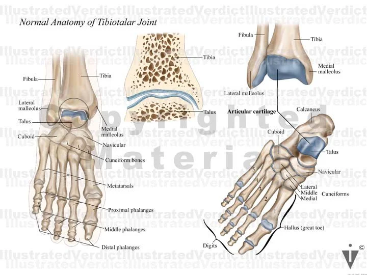 CASE AT A GLANCE: OCD (Osteochondritis Dissecans) of Talus ...