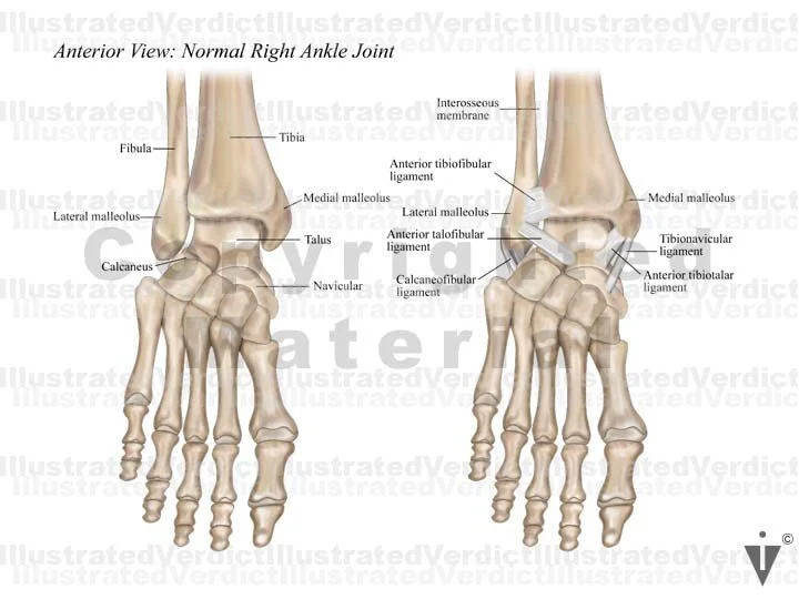 CASE AT A GLANCE: OCD (Osteochondritis Dissecans) of Talus ...