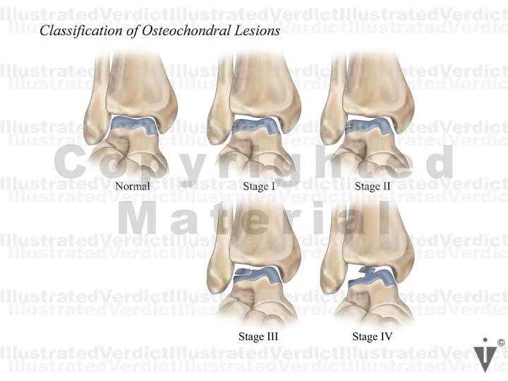 CASE AT A GLANCE: OCD (Osteochondritis Dissecans) of Talus ...
