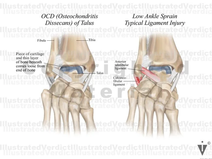 CASE AT A GLANCE: OCD (Osteochondritis Dissecans) of Talus ...
