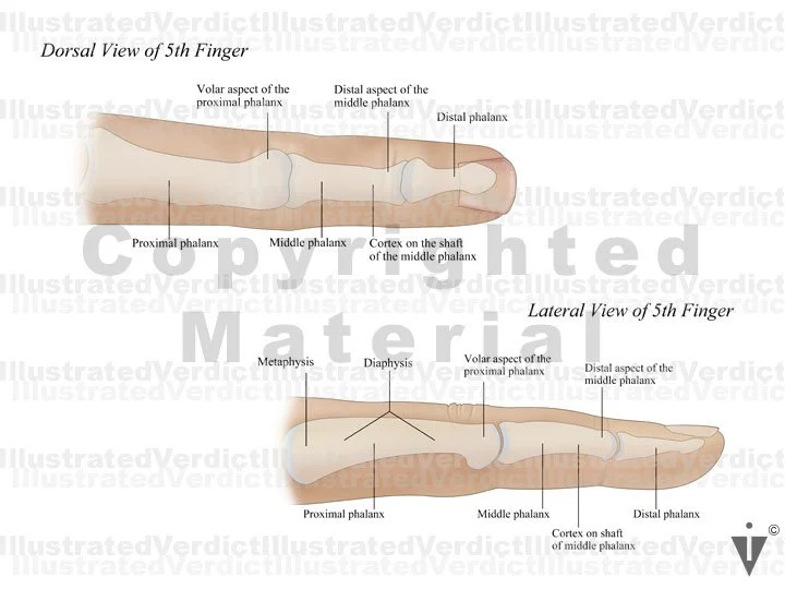 CASE AT A GLANCE: 5th Finger Fracture and Surgical Repair — Illustrated ...