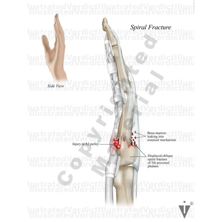 CASE AT A GLANCE: 5th Finger Fracture and Surgical Repair — Illustrated ...