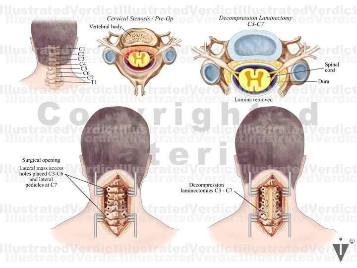 CASE AT A GLANCE: Post Op Hematoma Cervical Fusion — Illustrated Verdict