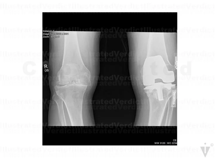 CASE AT A GLANCE: Failed Prosthesis of Total Knee Replacement ...
