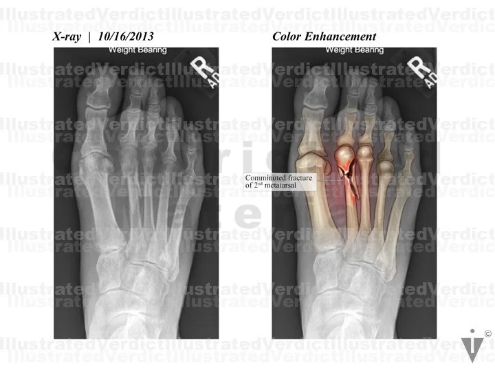 CASE AT A GLANCE: Foot Fracture / Chronic Pain — Illustrated Verdict