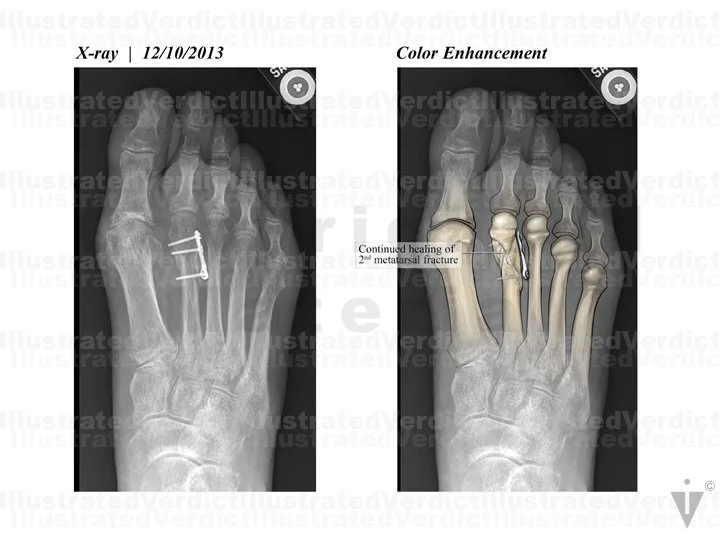 CASE AT A GLANCE: Foot Fracture / Chronic Pain — Illustrated Verdict