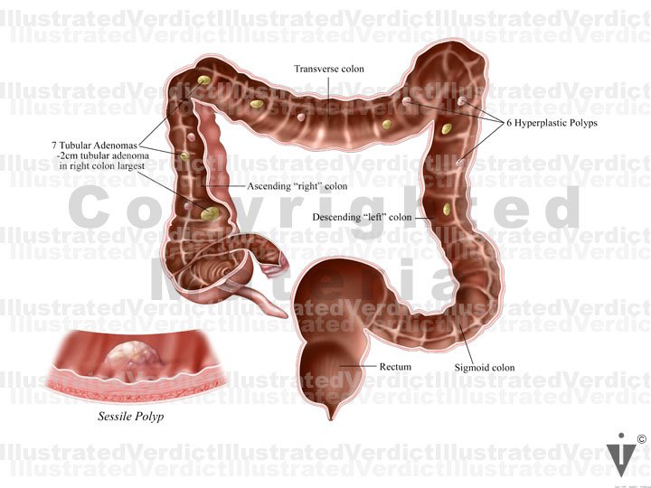 CASE AT A GLANCE: Subtotal Colectomy / Aortic Atherosclerosis ...