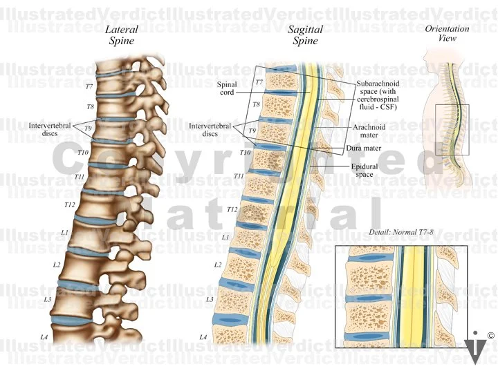 CASE AT A GLANCE: Electrode Placement on Thoracic Spine — Illustrated ...