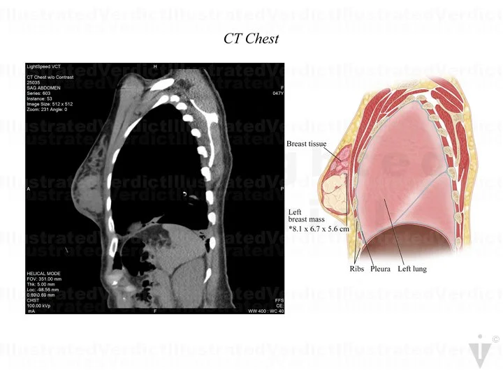 CASE AT A GLANCE: Biopsy of Breast Mass / Punctured Lung — Illustrated ...