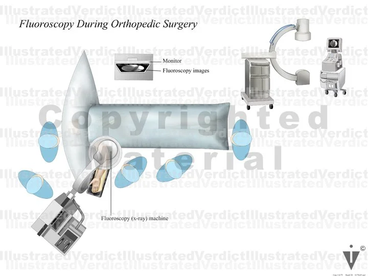 CASE AT A GLANCE: Elbow Re-Revision Replacement Surgery — Illustrated ...
