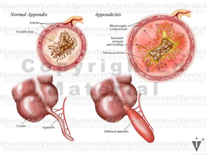 CASE AT A GLANCE: Laparoscopic Appendectomy / Bowel Perforation ...