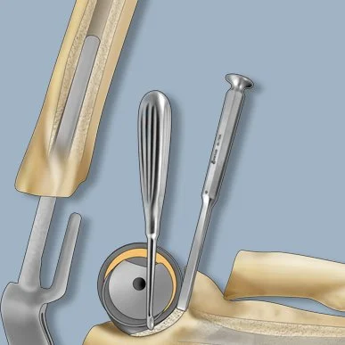 Iv Spotlight Illustrated Verdict
