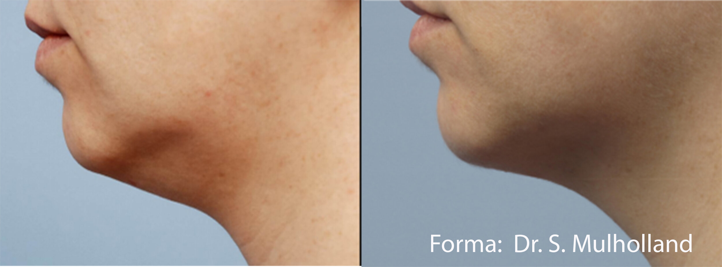 Forma Skin Tightening — Renew Skin Clinic Ltd.