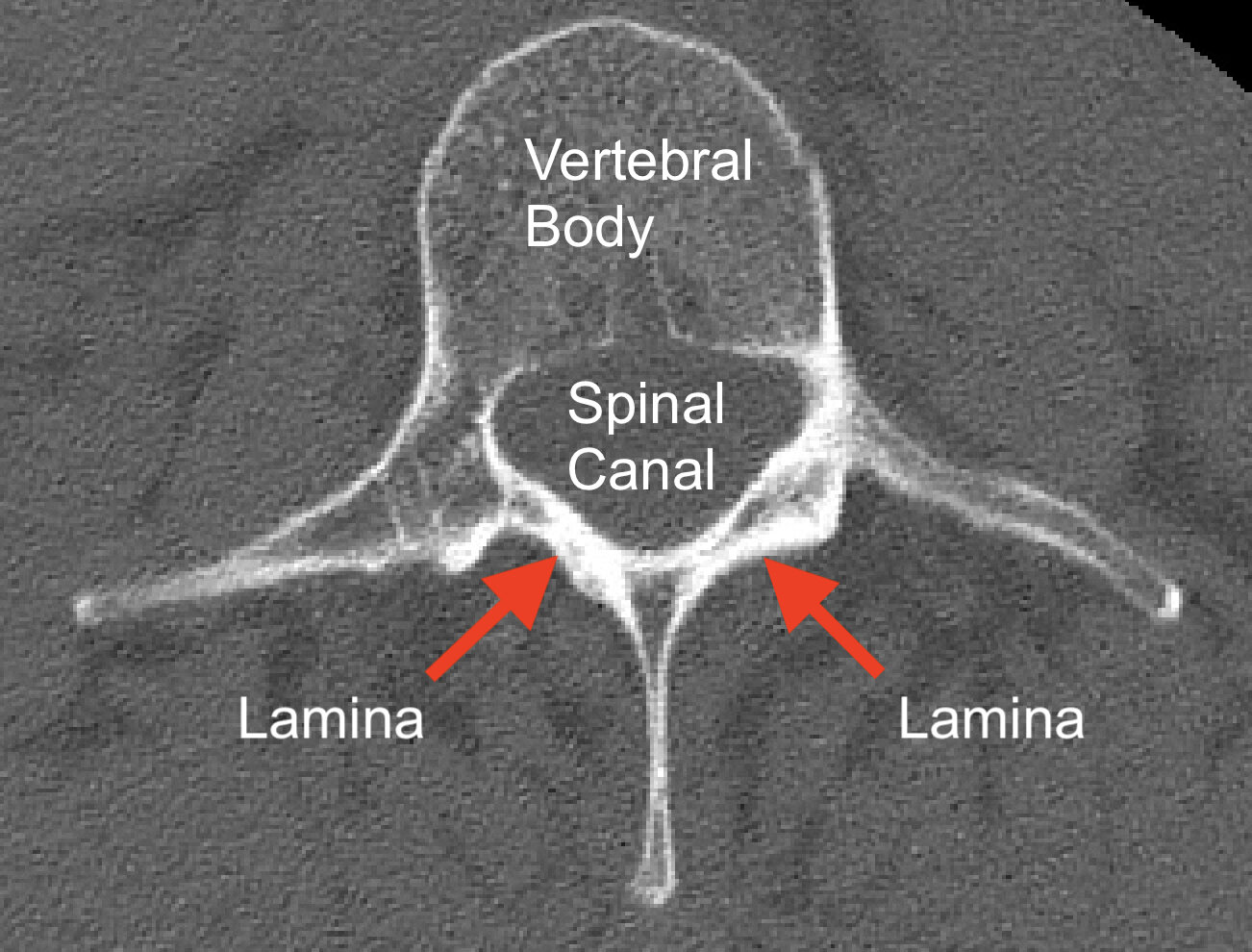 Laminectomy — Matthew Mian, MD