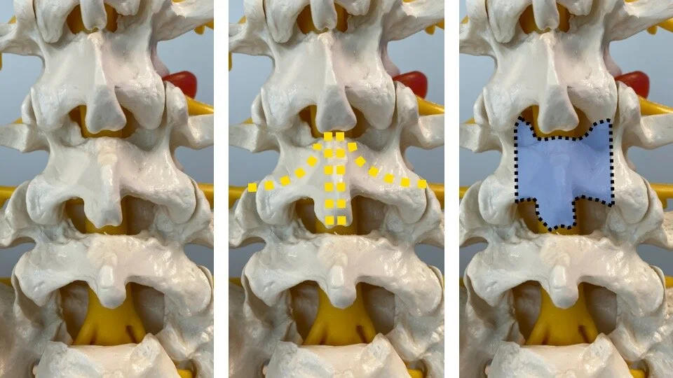 Laminectomy — Matthew Mian, MD