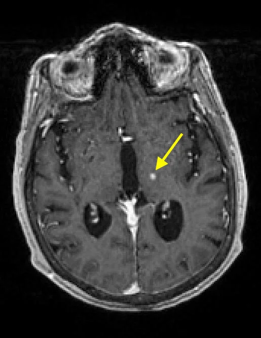 Thalamotomy — Matthew Mian, MD