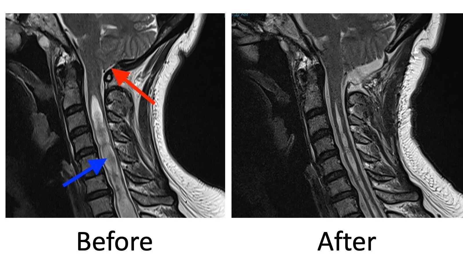 Chiari Malformation Matthew Mian MD