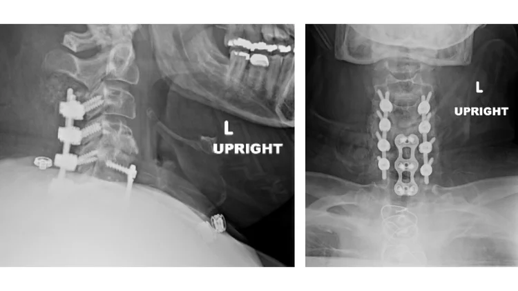 Spinal Fusion — Matthew Mian, MD